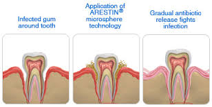 Gum disease treatment may include ARESTIN + Scaling and root planing ...